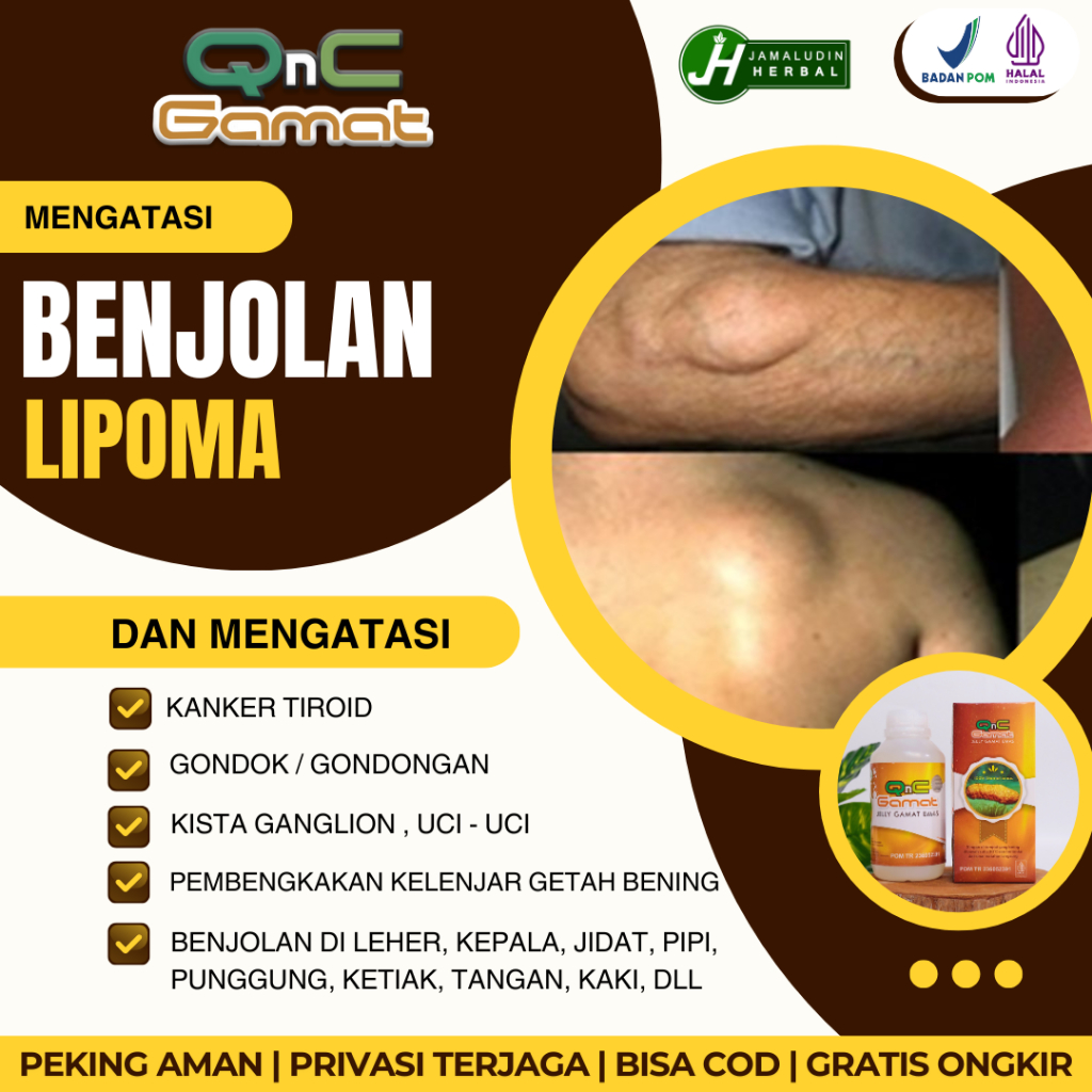 Jual Obat Herbal Penghilang Benjolan Lipoma Di Tangan Kanan/Kiri ...