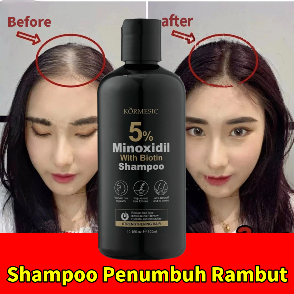 Jual 300ml Shampo Minoxidil 5% Shampo Penumbuh Rambut Cepat pertumbuhan rambut Pengendalian ...