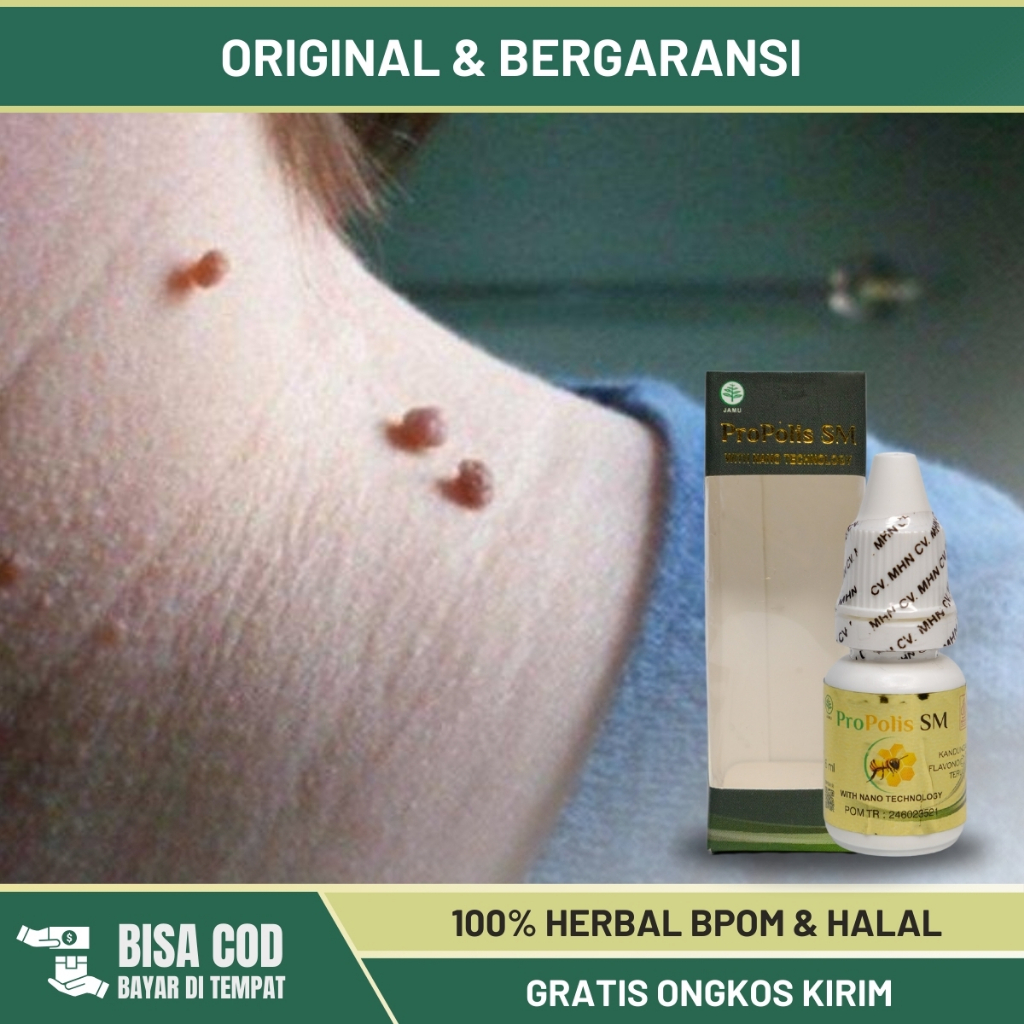 Jual Obat Papiloma Penghilang Kutil di Leher Skin Tag Daging Jadi ...