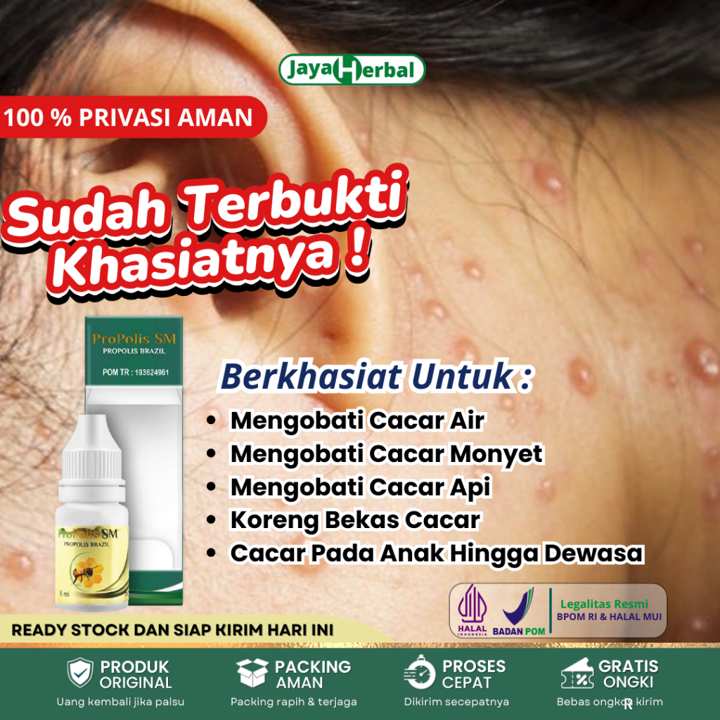 Jual Obat Cacar Air, Obat Cacar Monyet Monkeypox, Obat Cacar Api, Obat ...