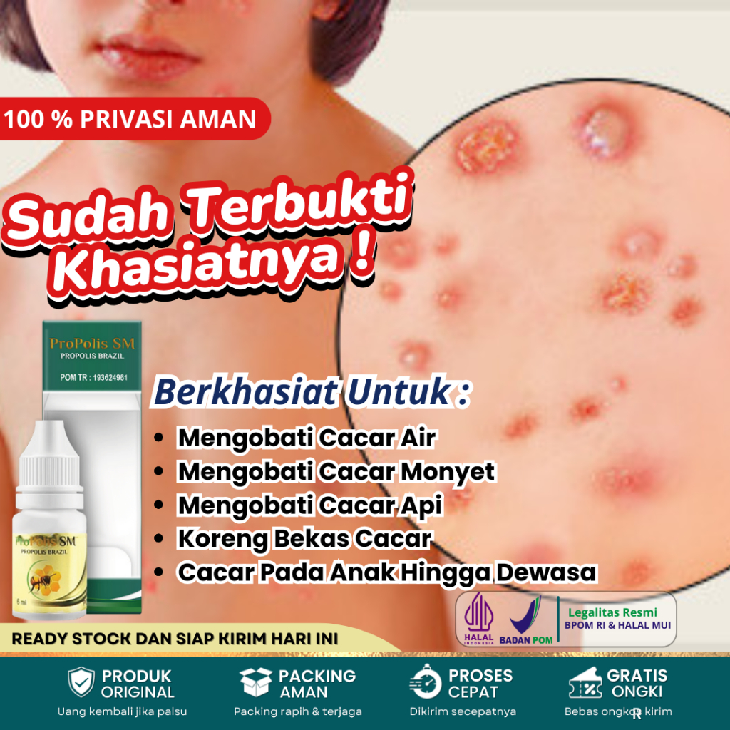 Jual Obat Cacar Air, Cacar Api, Cacar Monyet, Obat Cacar Anak dan ...