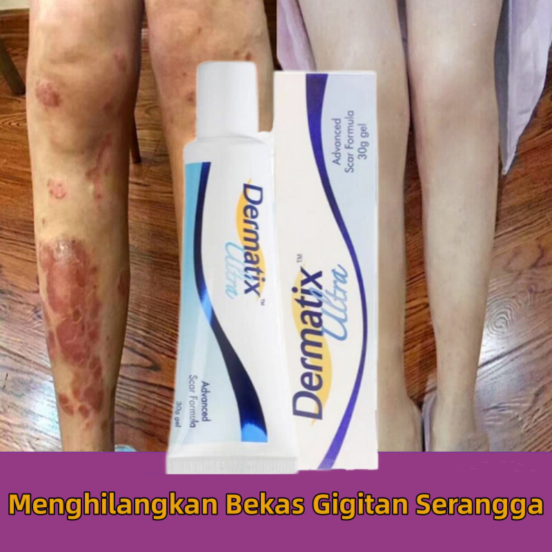Jual Dermatix Ultra Cream 15g Salep Penghilang Bekas Luka Menghilangkan ...