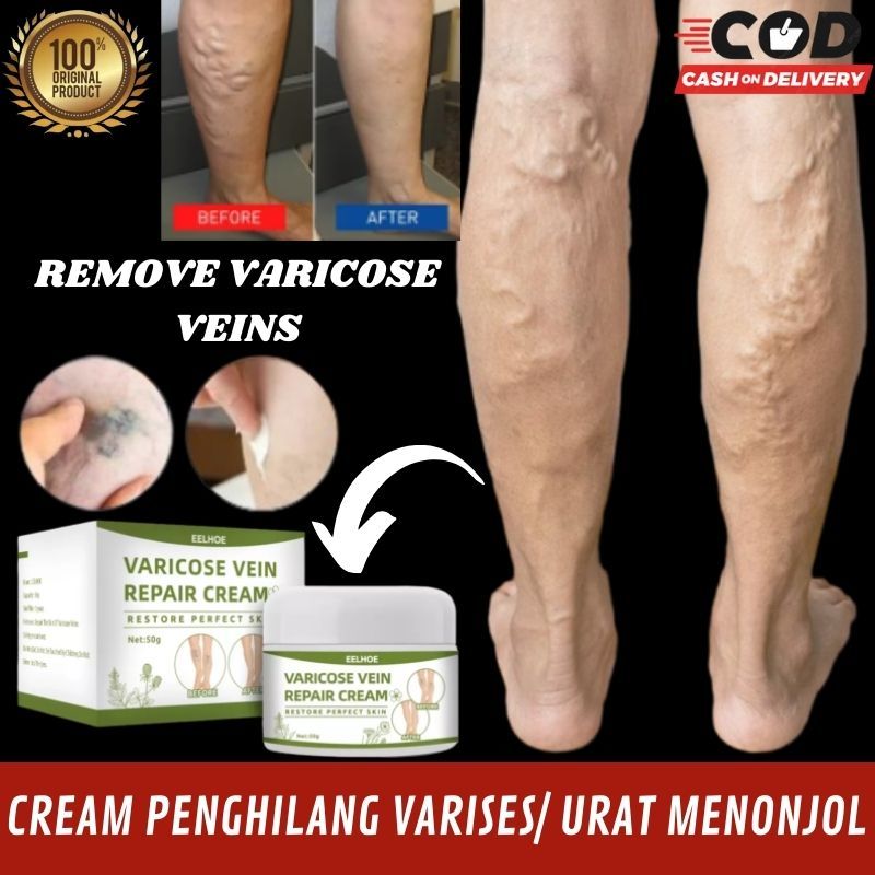 Jual [Best Seller] Krim Salep China Untuk Pengobatan Varises kaki ...