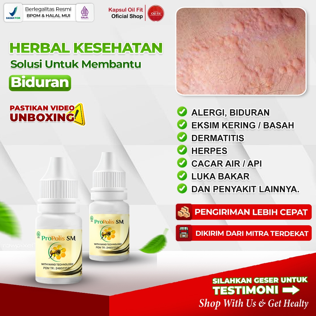 Jual Obat Biduran Alergi Dingin Gatal gatal Kulit Bentol Bentol Ruam ...