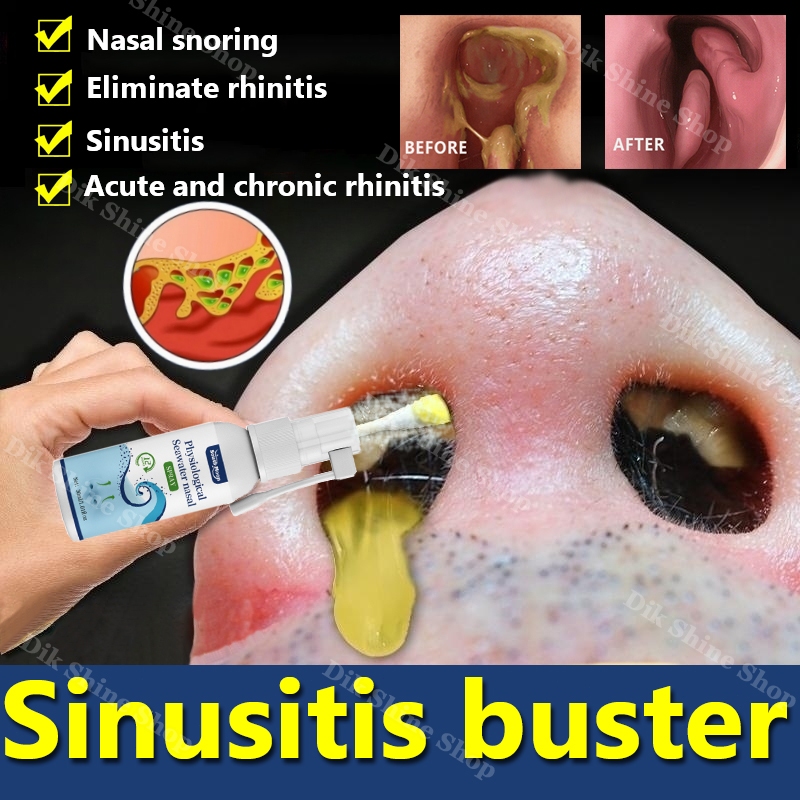 Jual Sinusitis Semprotan Hidung Obat Polip Hidung Nasal Spray Obat ...