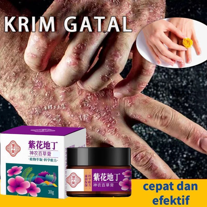 Jual Obat salep gatal kulit paling ampuh Obat gatal selangkangan Eczema ...