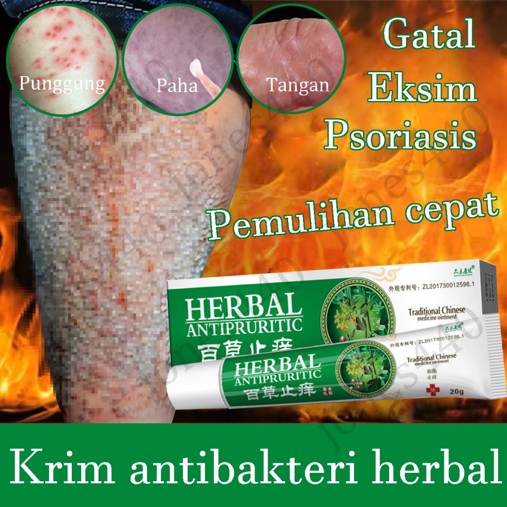 Jual Obat gatal Salep eksim Obat psoriasis [100% Original] Cream Kulit ...