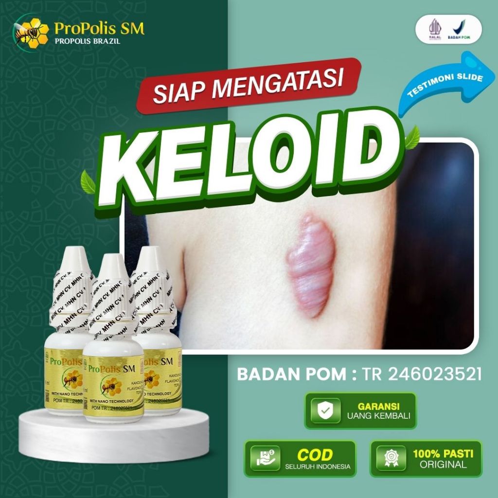 Jual Obat Keloid, Keloid Menahun, Daging Jadi, Daging Tumbuh Luka Tindik Bekas Operasi Caesar ...