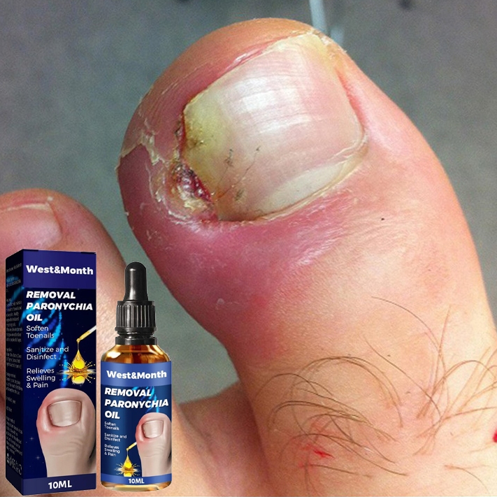 Jual kuku cantengan Obat kuku jamur dan rusak Obat cantengan Nail ...