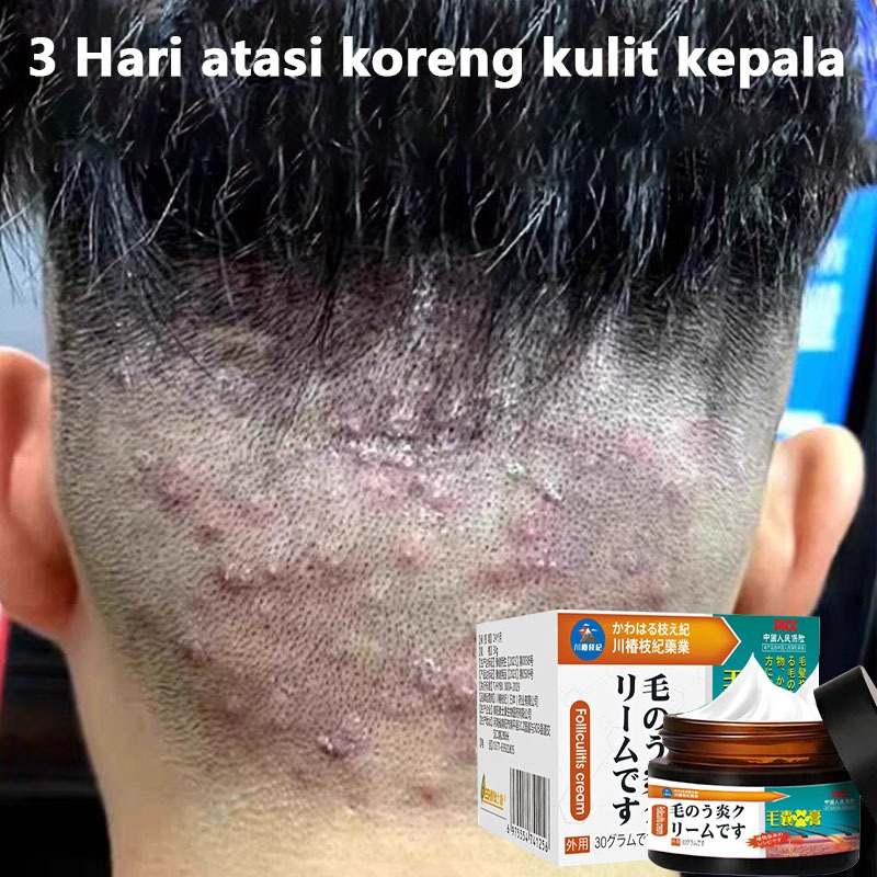 Jual Obat ulserasi kepala 20g, psoriasis kepala, folikulitis kepala, atasi gatal kulit kepala ...