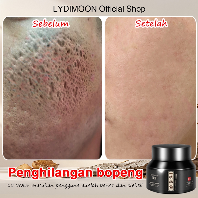 Jual Cream Penghilang Bekas Jerawat | Bopeng,dan Flek | penghilang ...