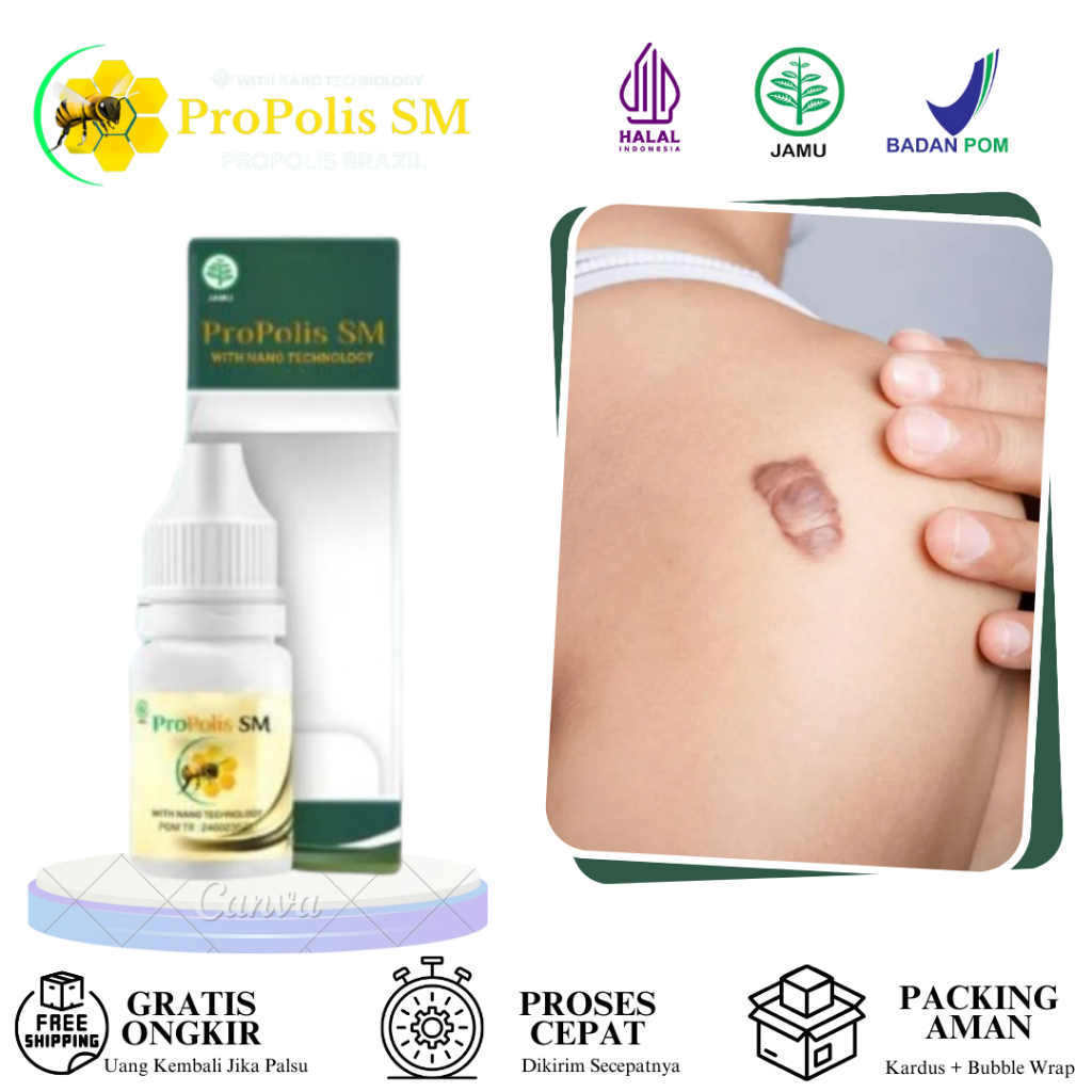 Jual Obat Keloid Menonjol Berkerut, Daging Tumbuh, Penghilang Keloid Luka Tindik Di Telinga ...
