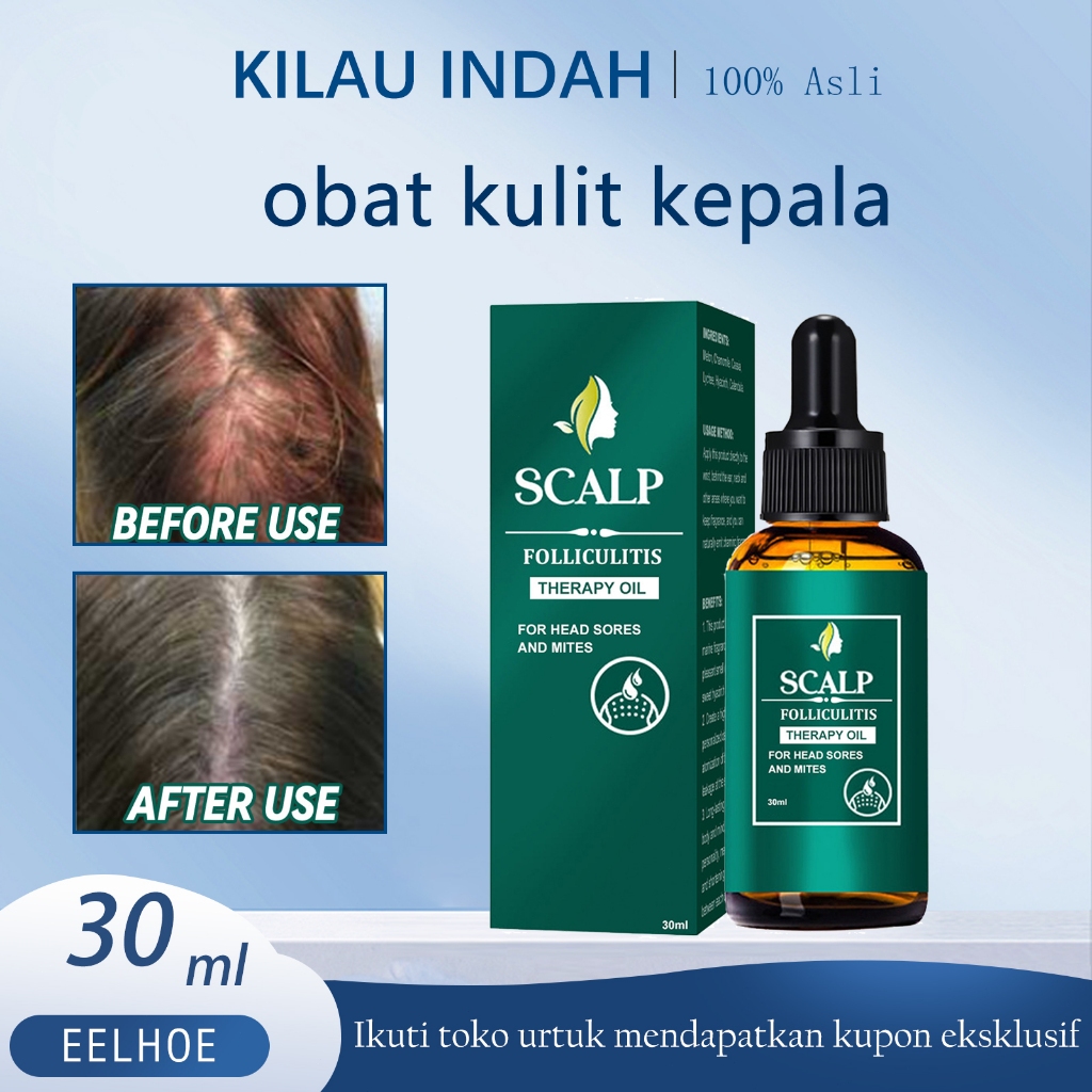 Jual Obat kulit kepala 30ml Scalp Folliculitis Essential Oil Obat Borok ...