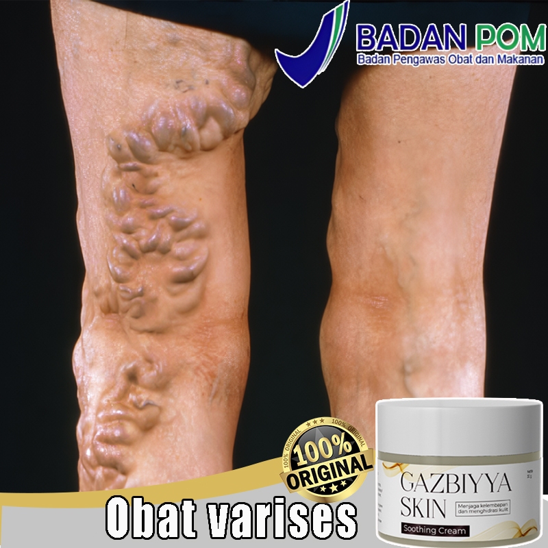 Jual Obat varises Varicose veins cream Salep varises Salep varises ...