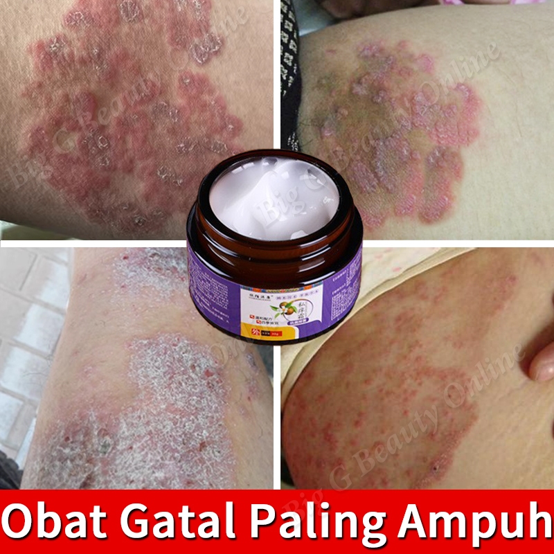 Jual Salep Gatal Selangkangan Anti Jamur Obat Gatal Kelamin Salep Gatal ...