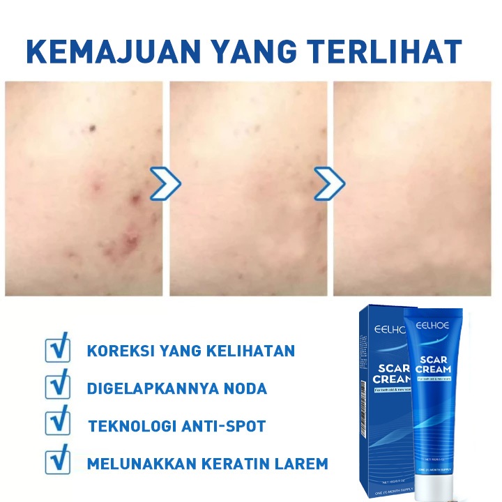 Jual Scar Removal Cream Repairing Pock Mark Burn Surgical Scar Cesarean ...