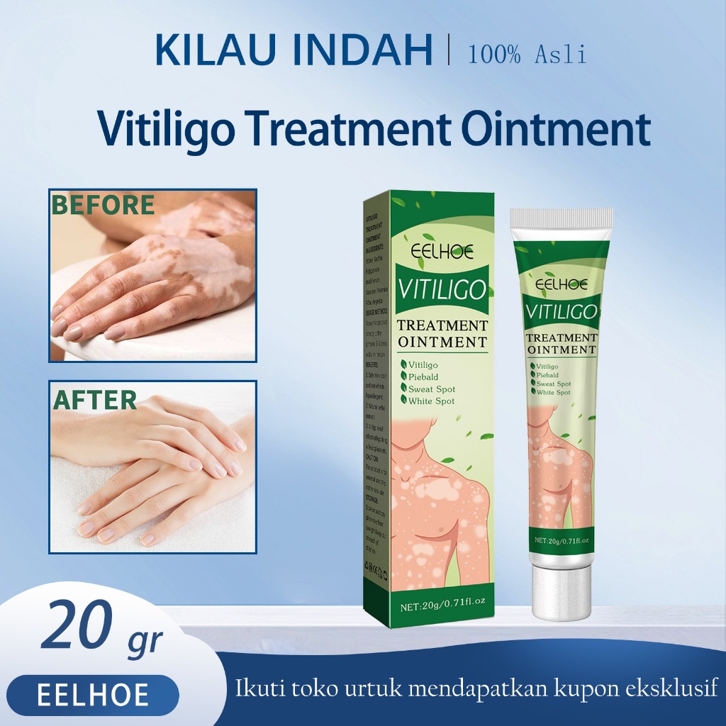 Jual Obat vitiligo Salep vitiligo ampuh 20g 100% ori White spot ...