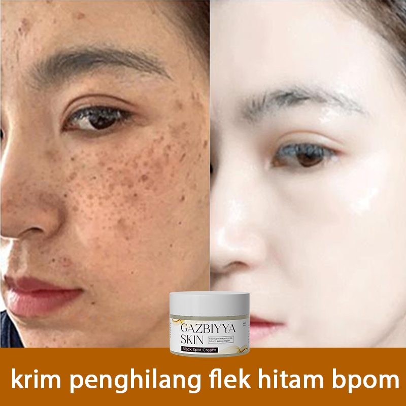 Jual [BPOM]Cream flek hitam membandel bpom krim penghilang flek hitam ...
