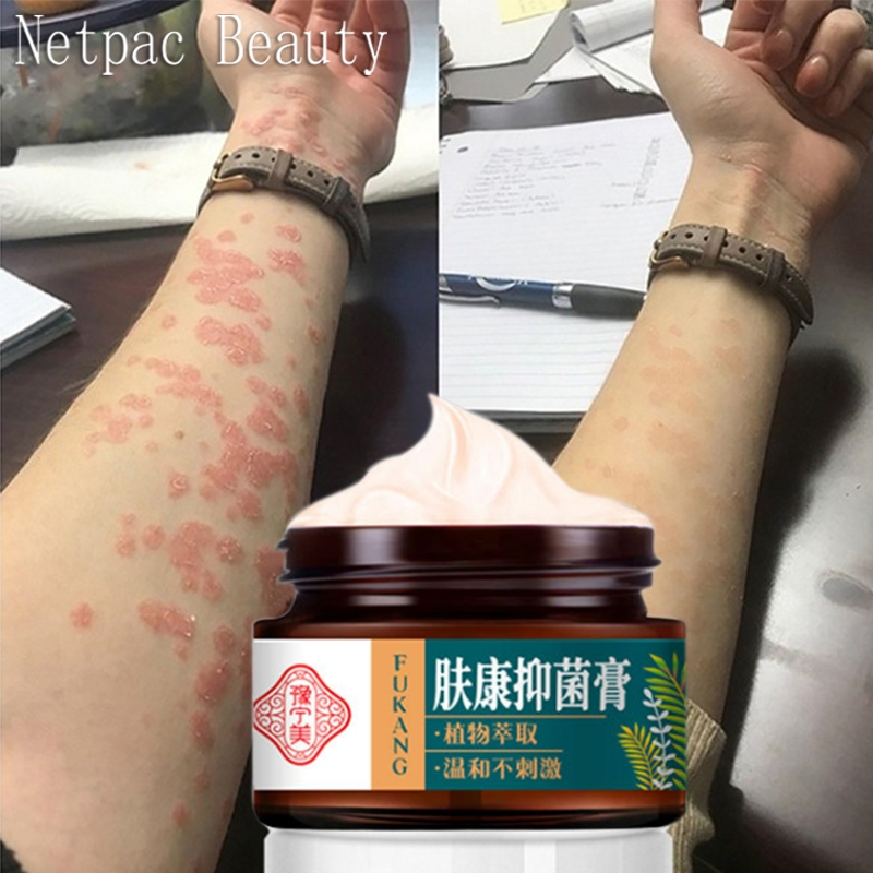 Jual Obat gatal Salep eksim Obat psoriasis 30G [100% Original] Salep ...