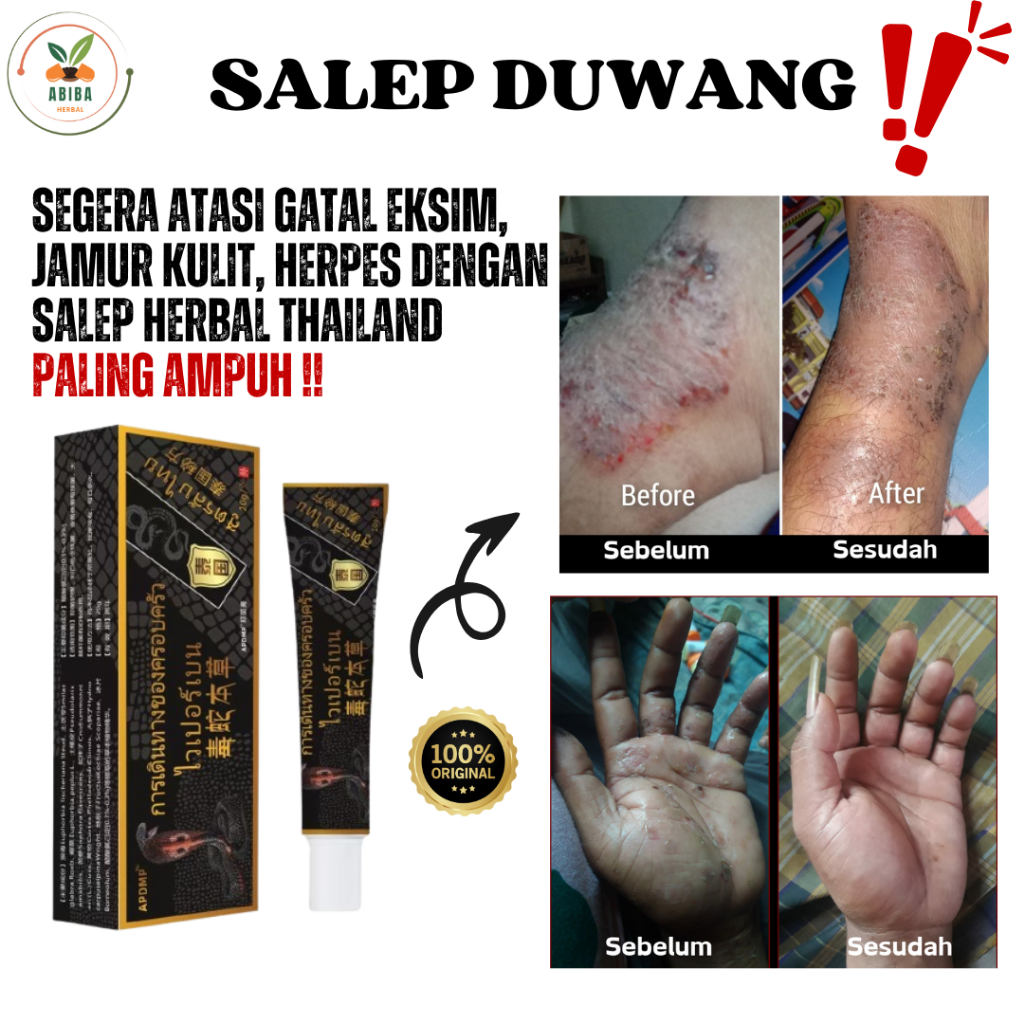 Jual Salep Gatal Thailand Paling Ampuh Sembuhkan EKSIM, KADAS, KUDIS ...