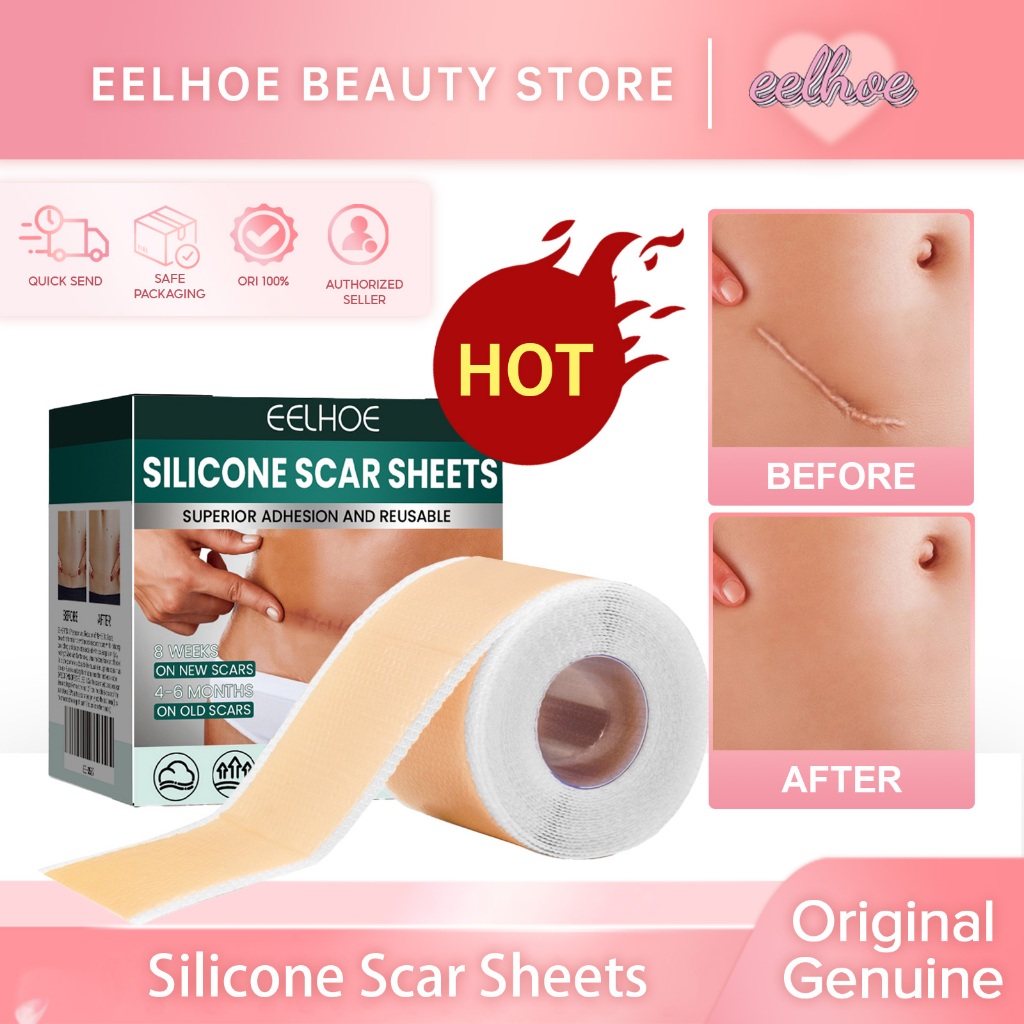 Jual EELHOE Silicone Scar Sheets 1Roll Plester Silikon Penghilang ...