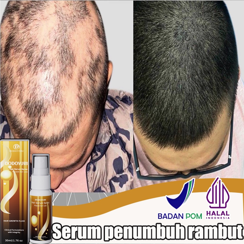 Jual Serum penumbuh rambut Obat penumbuh rambut Penumbuh rambut botak ...