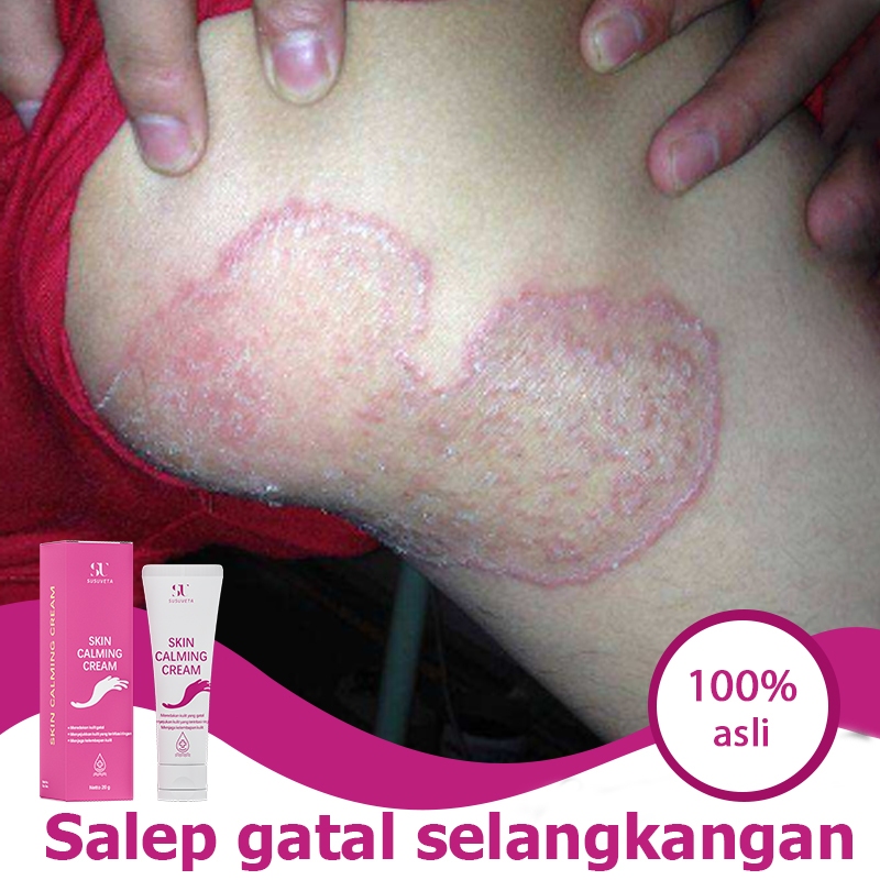 Jual Salep gatal selangkangan salep gatel salep gatal china paling ...