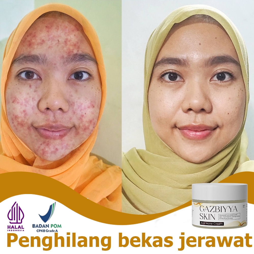 Jual 【BPOM】Obat jerawat cream jerawat dan bekas jerawat menghilangkan bekas jerawat 30g obat ...