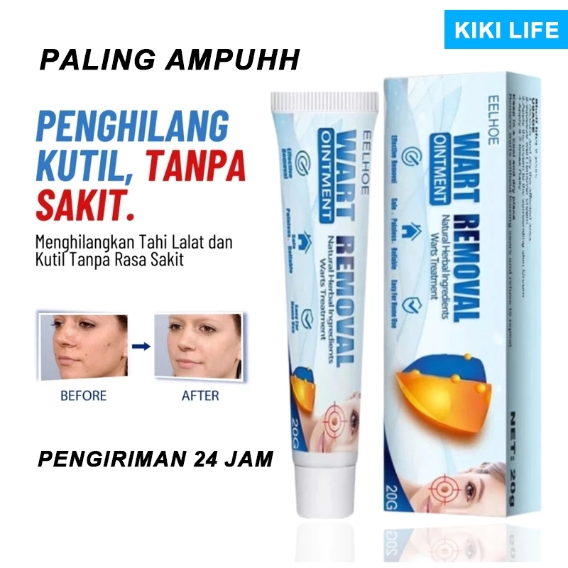 Jual Penghilang Kutil Dan Tahi Llat Wart Removal Cream Krim Penghilang ...