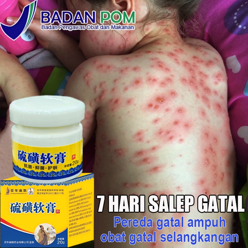 Jual krim belerang anti gatel krim salep eksim kering paling ampuh 20g ...