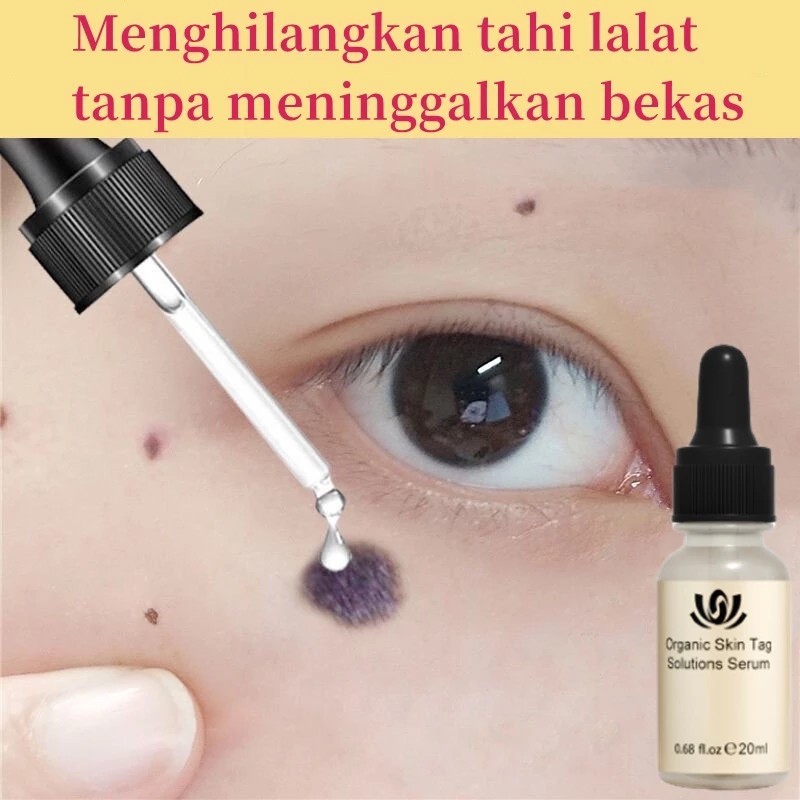 Jual Obat Penghilang Kutil Penghilang Tahi Lalat Dan Kutil Wart Removal ...