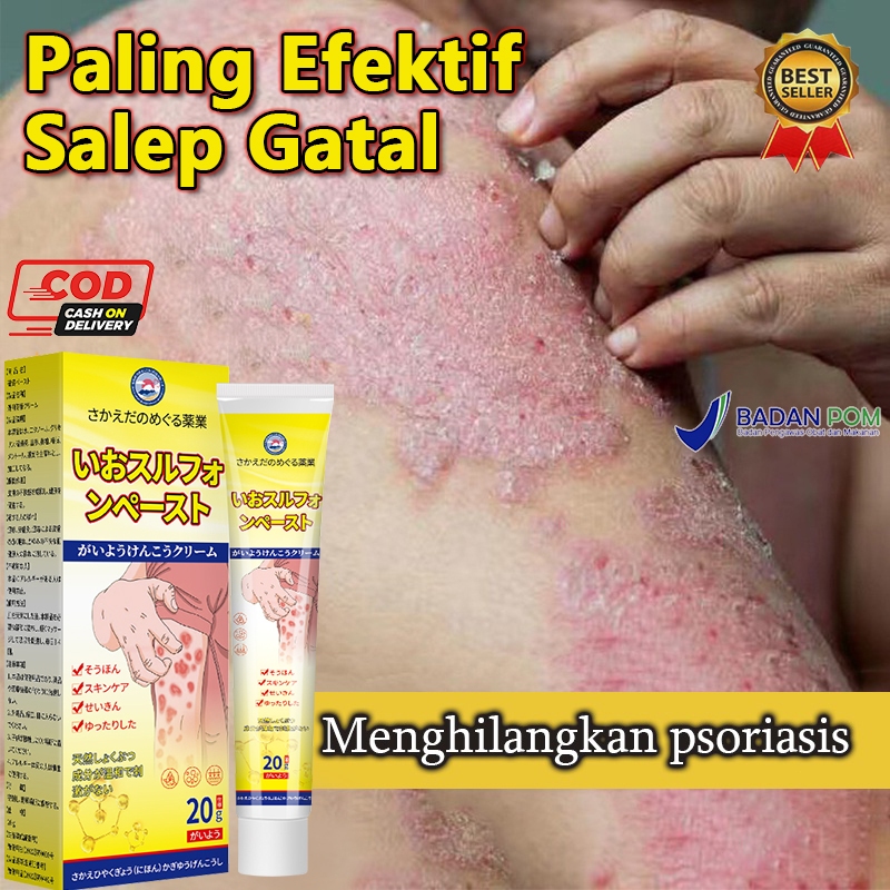 Jual Salep gatal paling ampuh Obat psoriasis obat gatal salep kutil ...