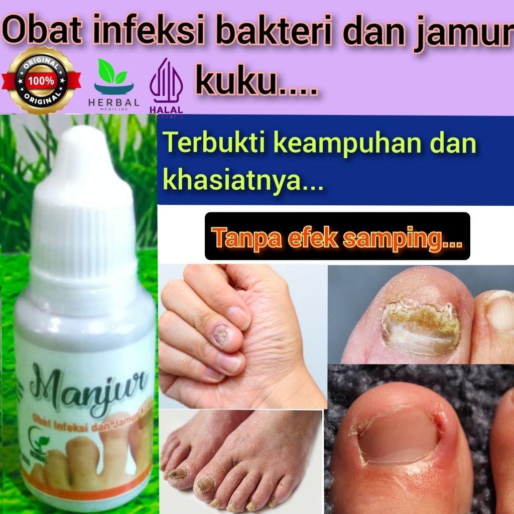Jual obat kuku anti jamur dan bakteri.bernanah cantengan gatal bau ...