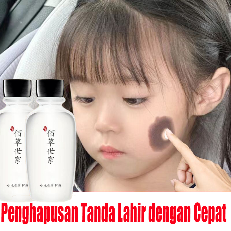 Jual Obat penghilang tanda lahir Penghilang tanda lahir coklat, hitam ...