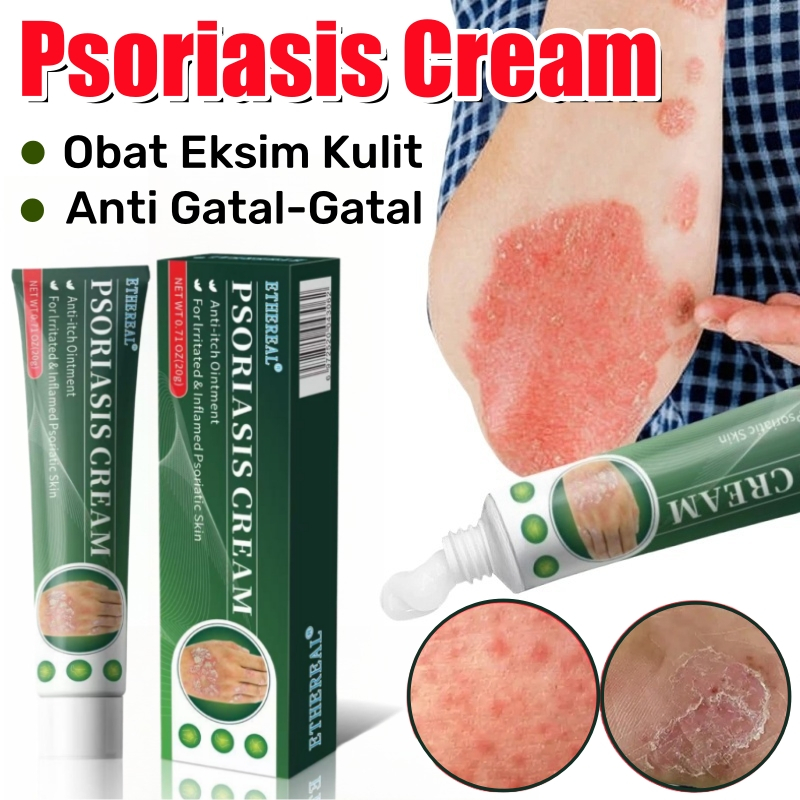 Jual Psoriasis Cream Original Obat Gatal Kulit Eksim Salep Gatal Kulit ...