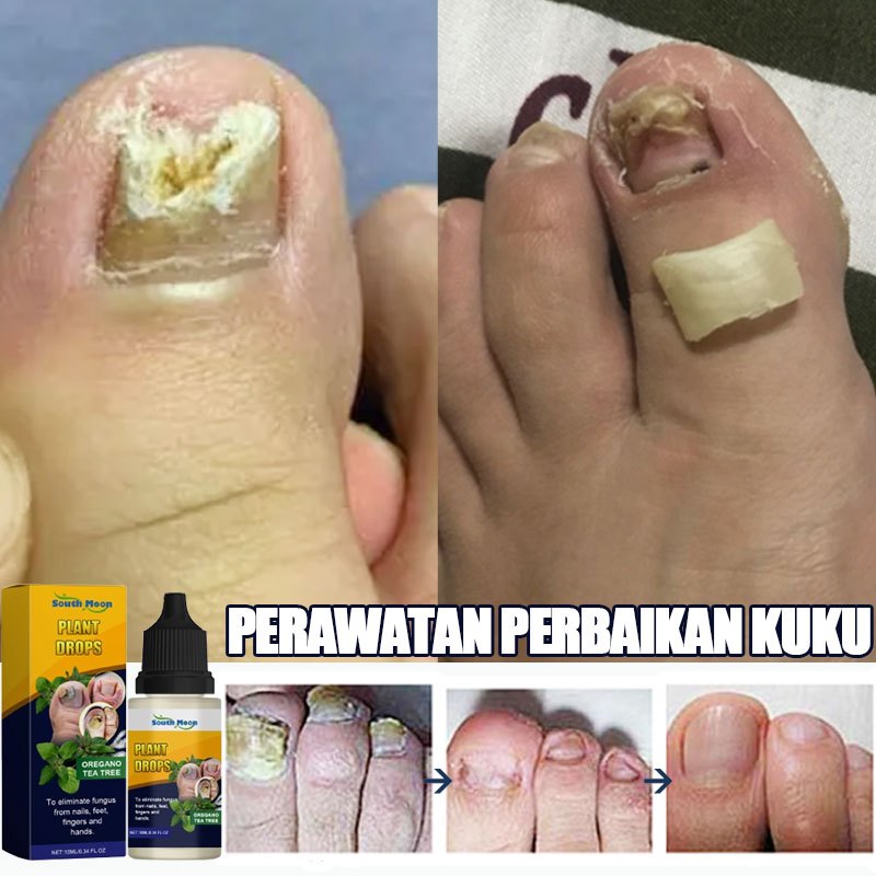 Jual Jamur Kuku Kaki Obat Kuku Berjamur Obat Kuku Jamur Dan Rusak ...