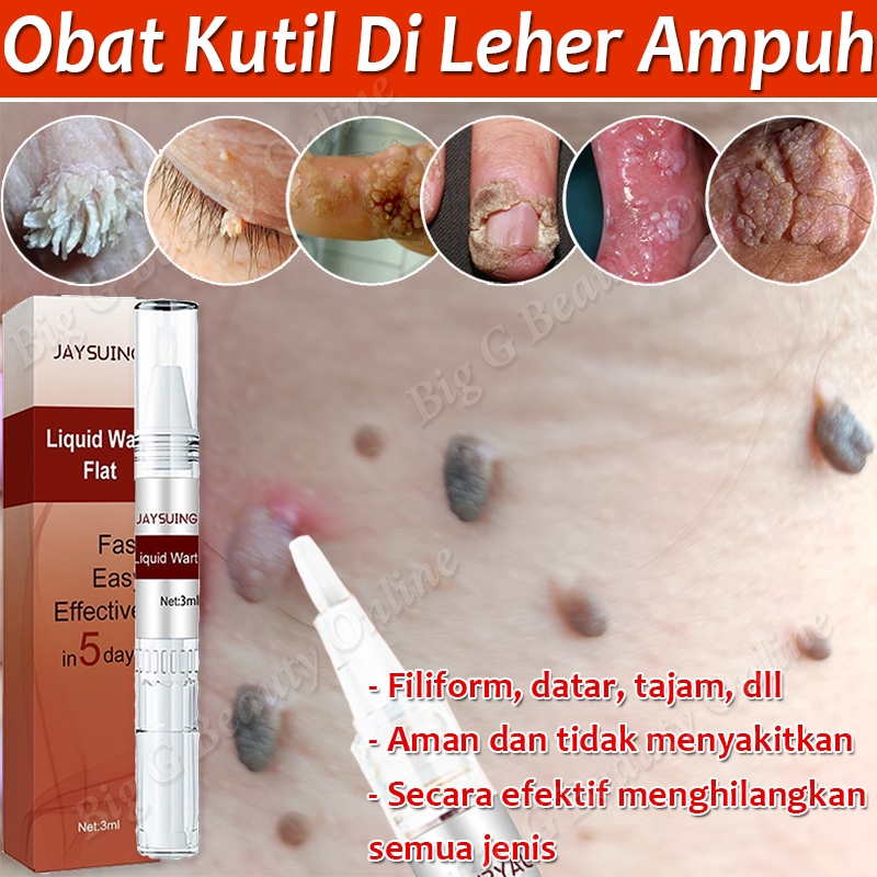 Jual Obat Penghilang Kutil Dan Tahi Lalat Penghilang Tahi Lalat Di ...
