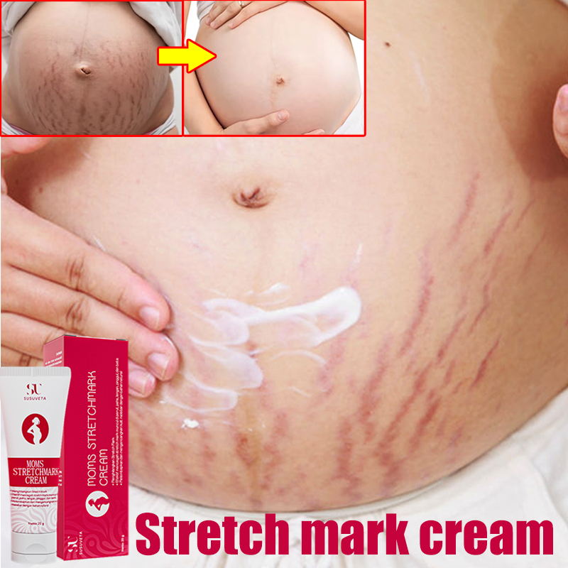 Jual Stretch mark Cream salep strechmark paling ampuh Stretch mark ...