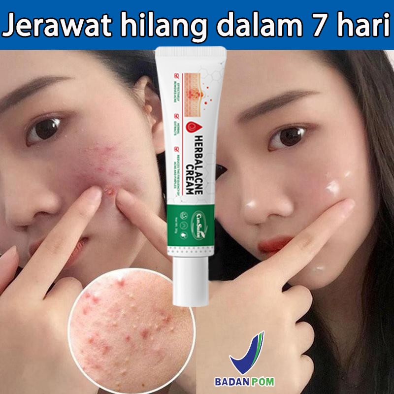 Jual 【BPOM】Krim Penghilang Jerawat Herbal penghilang jerawat anti ...