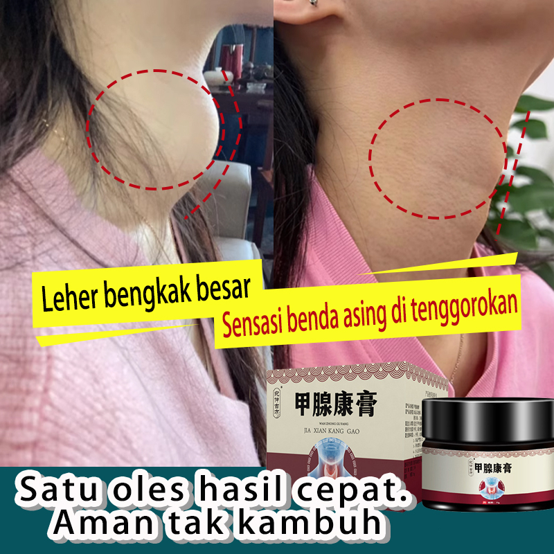 Jual 【BPOM】Krim Tiroid Salep Tiroid Herbal Obat Gondok Tiroid Obat ...
