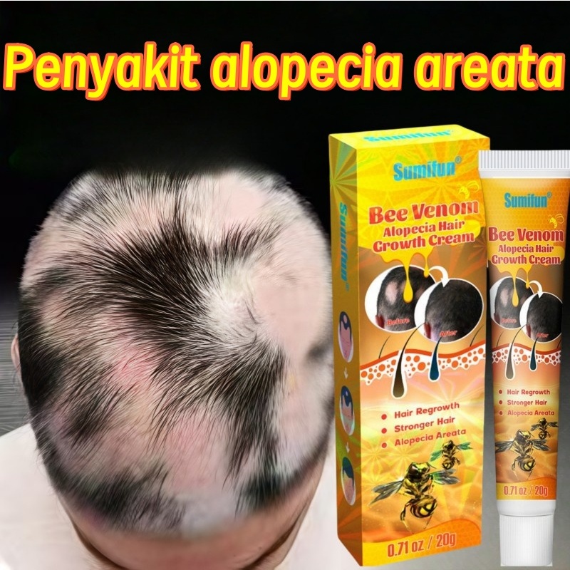 Jual SUMIFUN Obat Alopecia Areata, Obat Penumbuh Rambut Botak, Obat ...