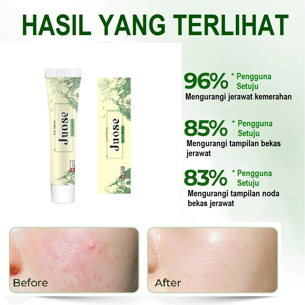 Jual Obat Cina Salep China Ampuh JerawatJuose Skincare Acne Cream ...