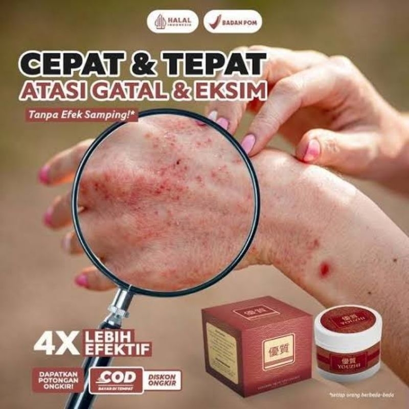 Jual SALEP YOUZHI MEMBANTU MENGATASI GATAL, EKSIM, ALERGI KULIT ...