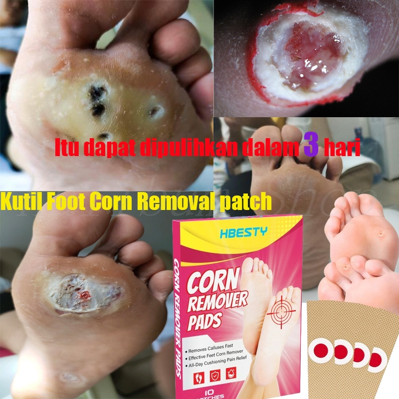 Jual Salep Mata Ikan Plester Kutil Mata Ikan telapak kaki obat mata ...