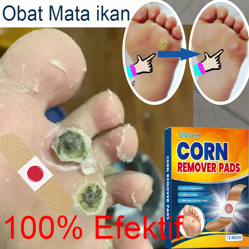 Jual Plester Kutil Mata Ikan Stiker Penghilang Kutil Penghilang mata ...