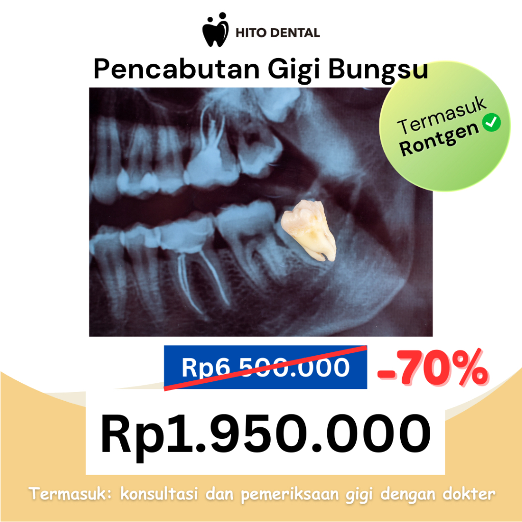 Jual Cabut Gigi Bungsu + Rontgen Panoramik + Konsultasi Dokter ...