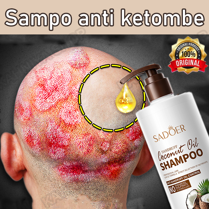 Jual Shampoo anti ketombe Sampo kutu rambut Dermatitis seboroik sampo ...