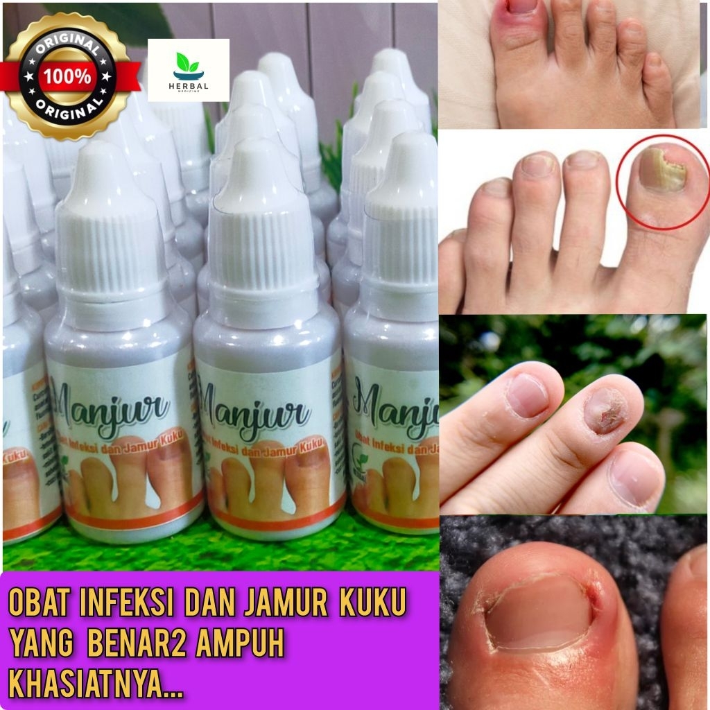 Jual Obat kuku cantengan jempol kaki tangan infeksi bakteri dan jamur ...
