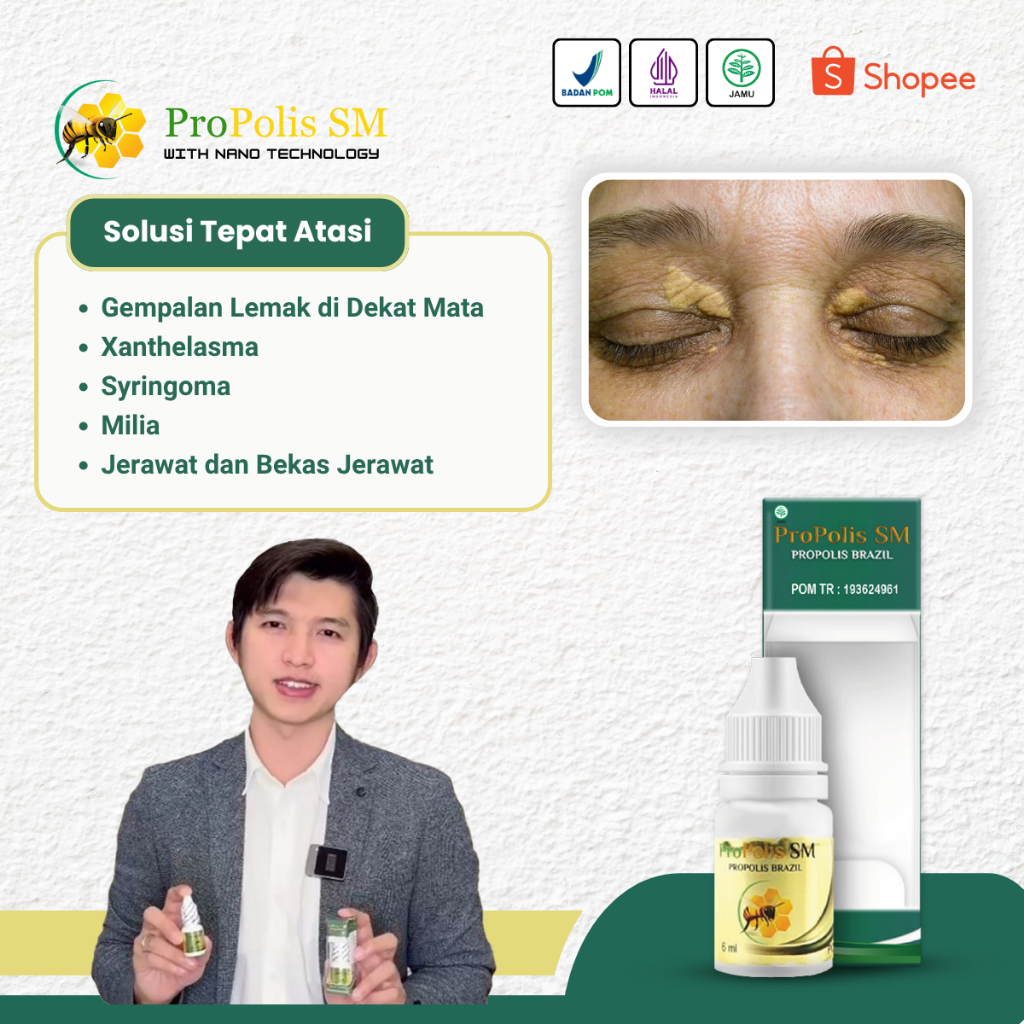 Jual Obat Penghilang Gumpalan Lemak Di Kelopak Mata Xanthelasma ...