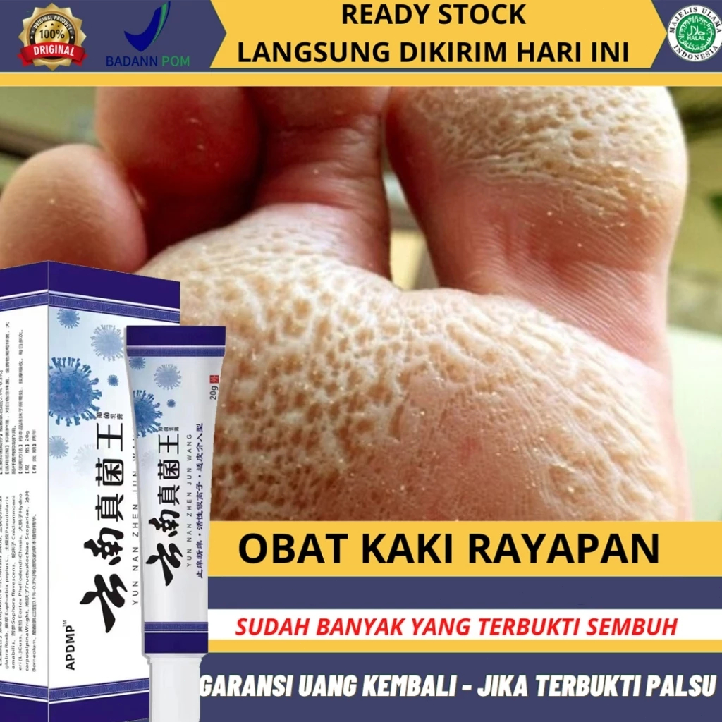 Jual Obat Kaki Rayapan Dan Bau Salep Yunnan Obat Gatal Krim Pengelupas ...